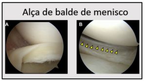 Lesão em alça de balde do menisco - Dr. João Hollanda