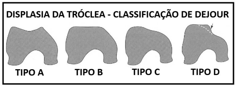 Displasia da tróclea (Tróclea rasa) - Dr. João Hollanda