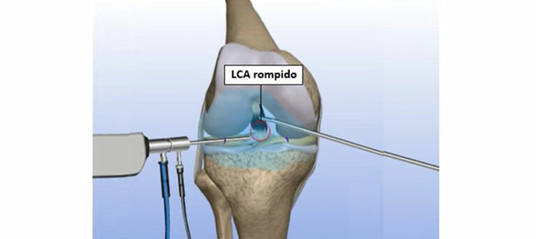 Lesão de Ligamento Cruzado Anterior (LCA) - Dr. João Hollanda